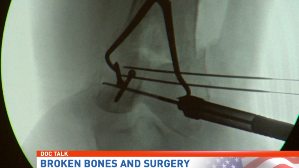 Doc Talk | Broken bones and surgery | WHP