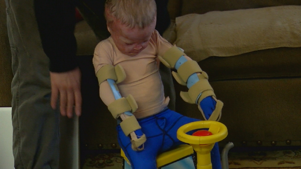 Severely burned toddler finally home, recovering after 5 months in ...